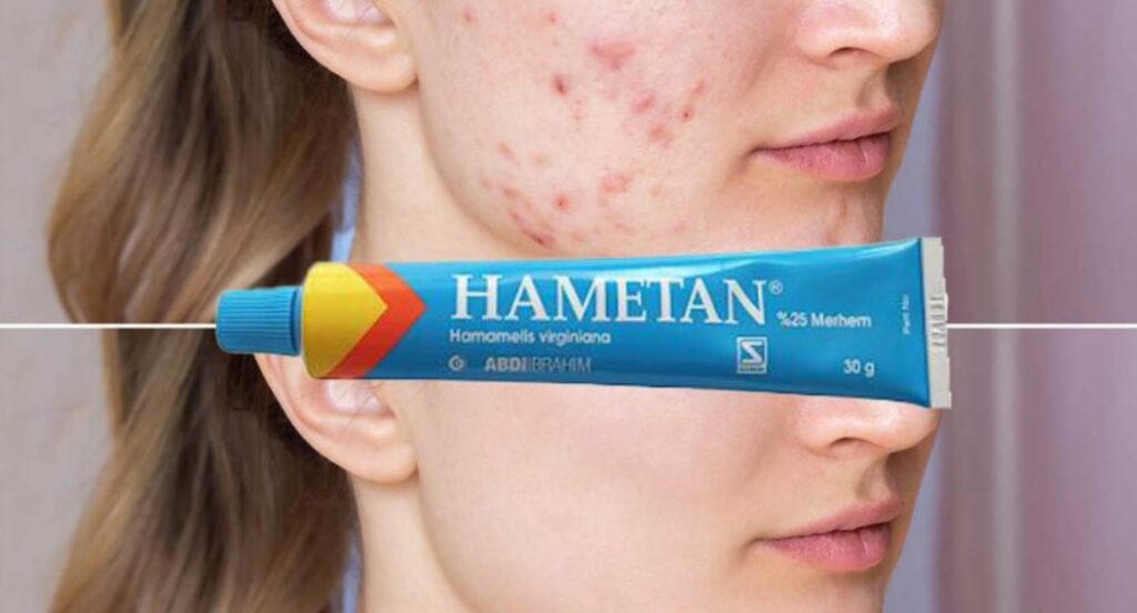Hametan Mavi Krem Ne İşe Yarar? Hametan Krem Neden Kullanılır? - SimliFar